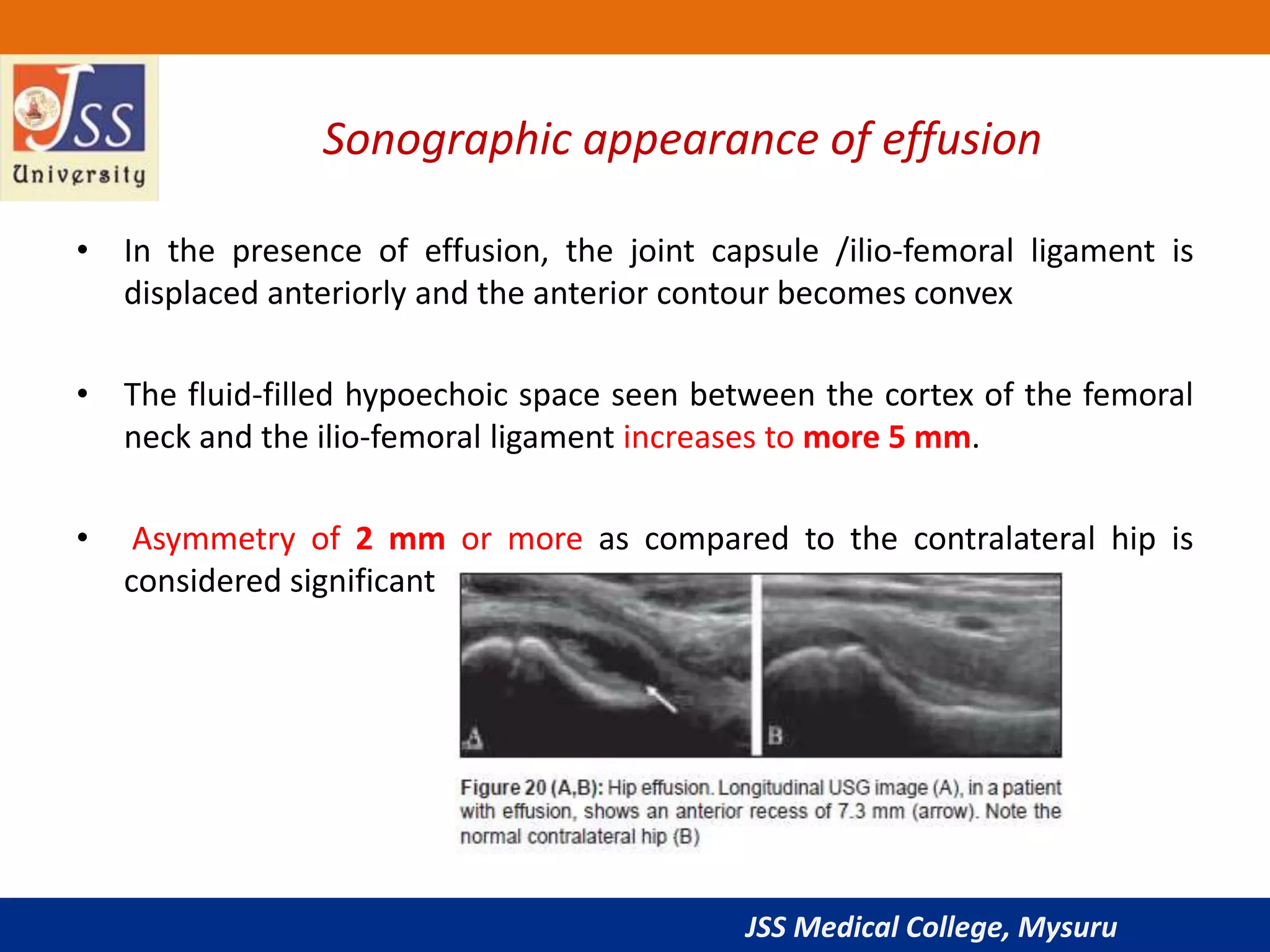 Hip ultrasonography in infants and children | PPTX