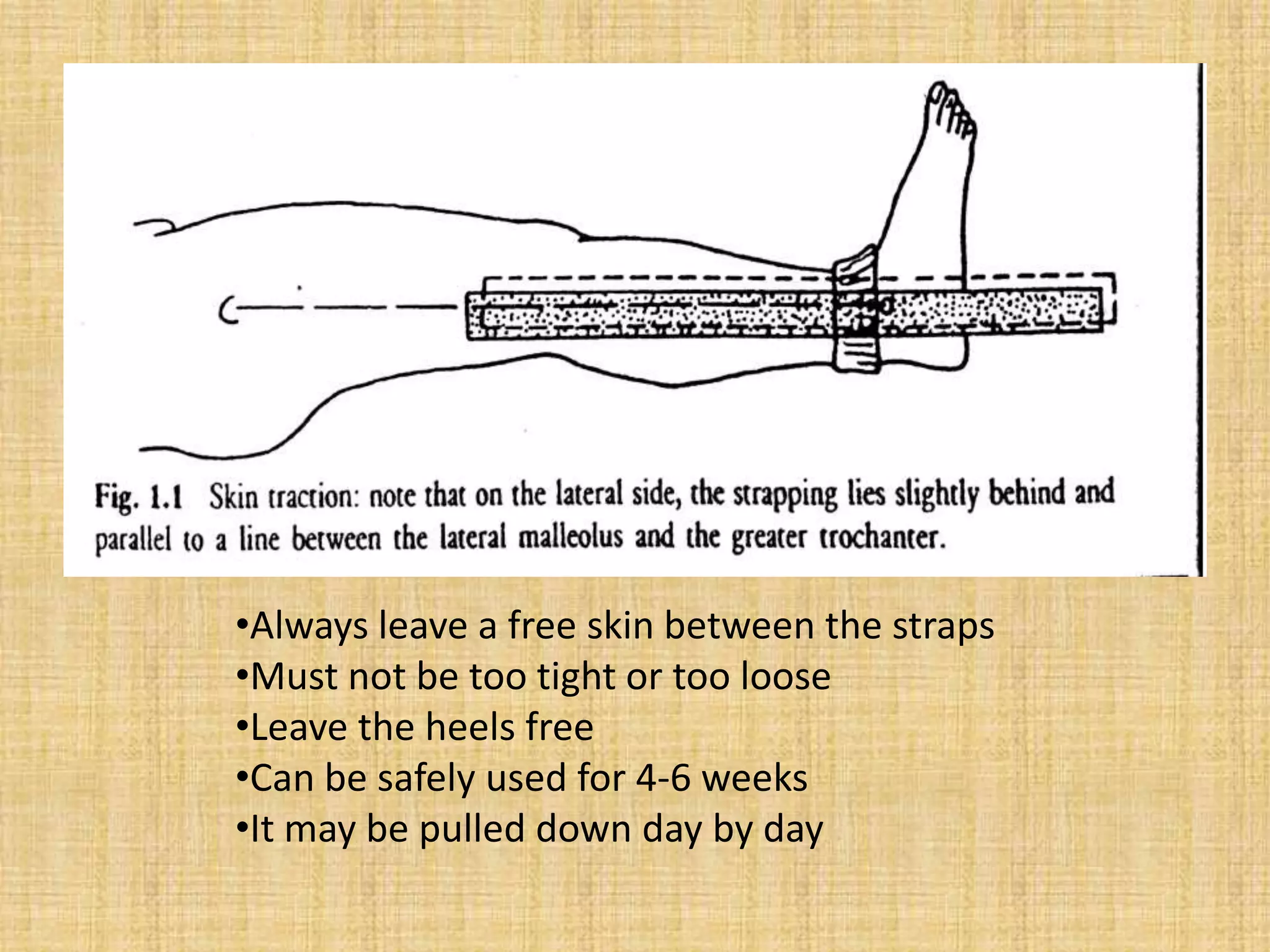 PPT ON TRACTIONS IN ORTHOPAEDICS | PPTX