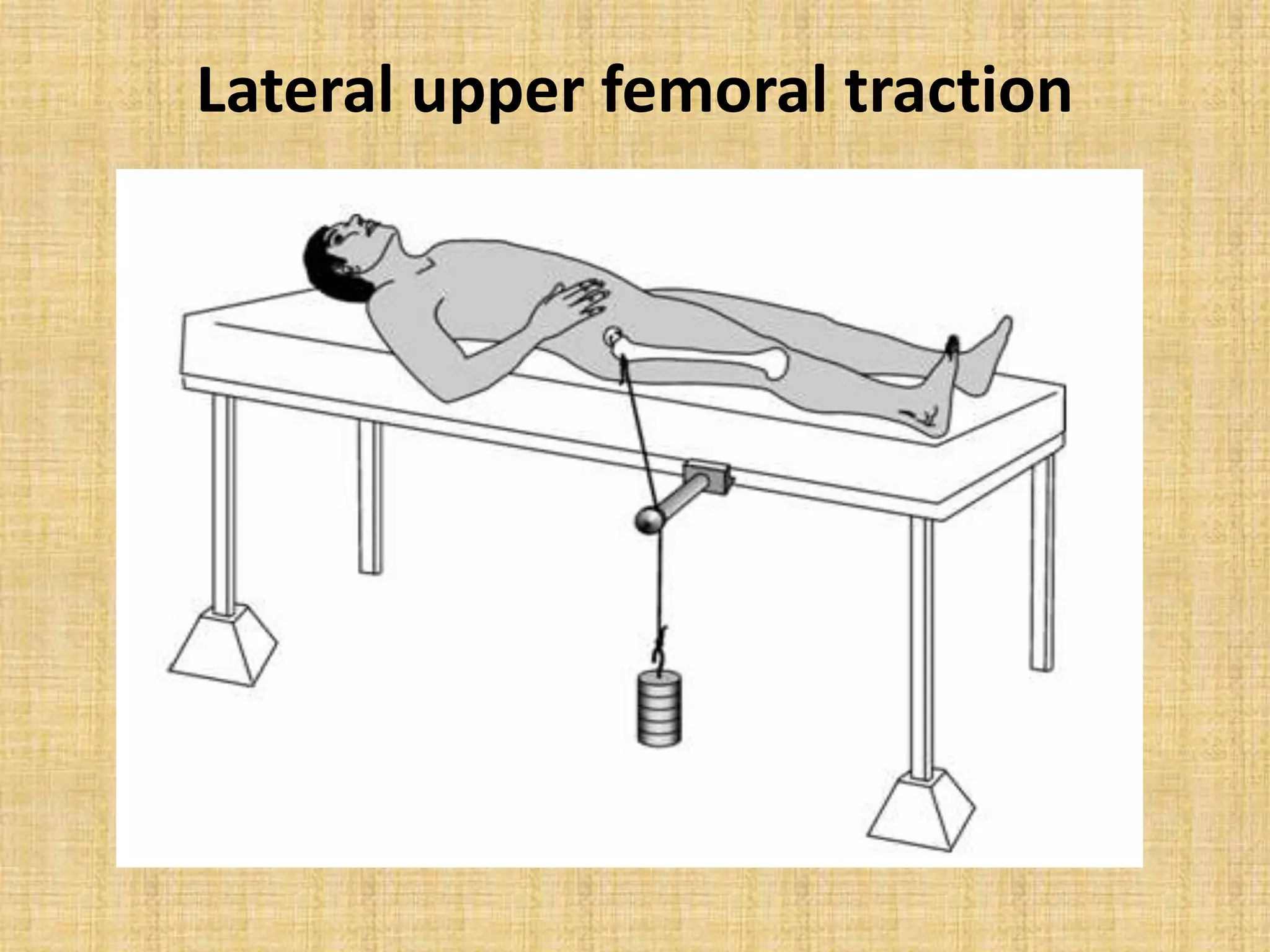 PPT ON TRACTIONS IN ORTHOPAEDICS | PPTX