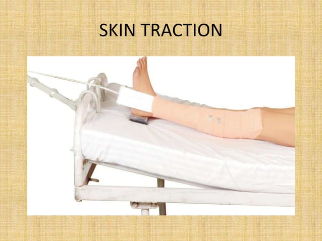 PPT ON TRACTIONS IN ORTHOPAEDICS | PPTX | Death, Injury, or Military ...
