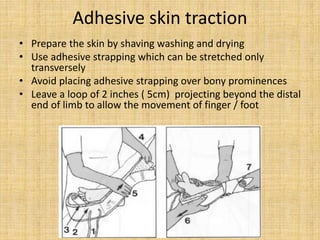 PPT ON TRACTIONS IN ORTHOPAEDICS | PPTX