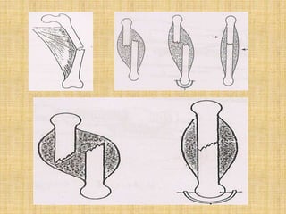 PPT ON TRACTIONS IN ORTHOPAEDICS | PPTX