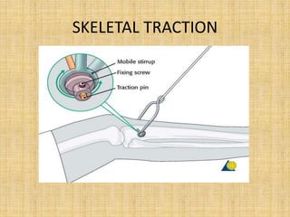 Skeletal Traction