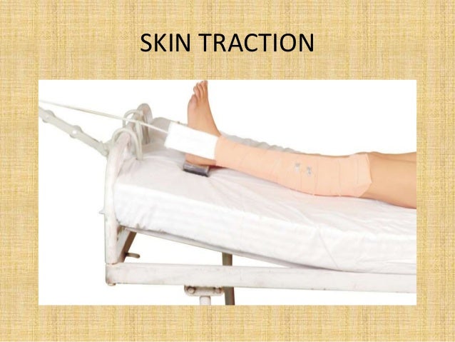 PPT ON TRACTIONS IN ORTHOPAEDICS