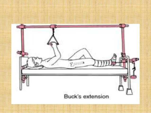 PPT ON TRACTIONS IN ORTHOPAEDICS