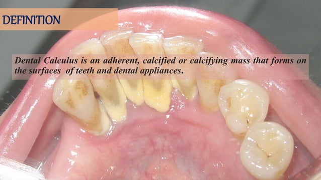 Dental calculus | PPTX | Dental Health | Diseases and Conditions