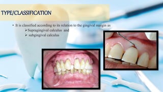 Dental calculus | PPTX