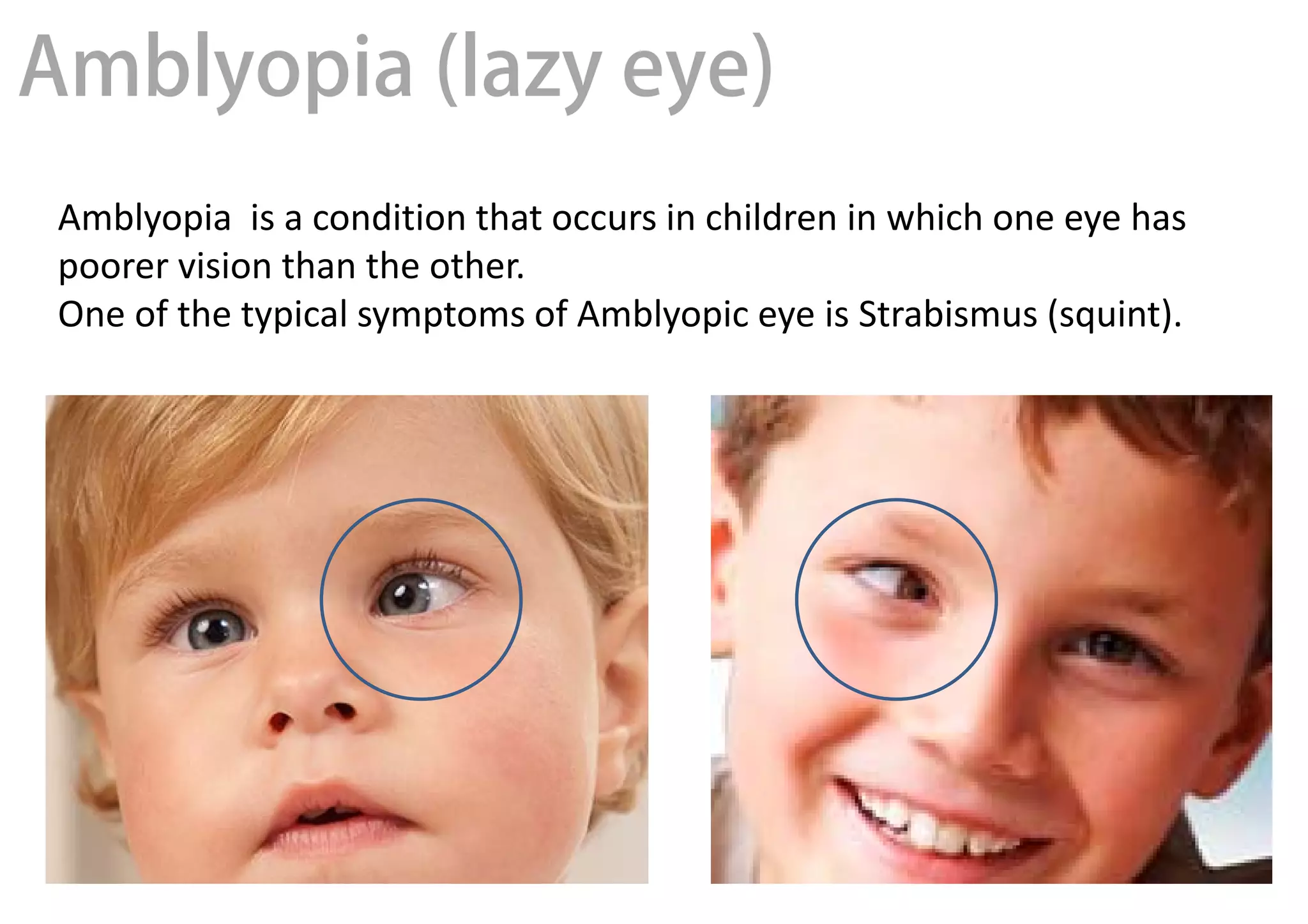 An innovative Amblyopia treatment methodology | PPT