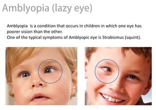 An innovative Amblyopia treatment methodology | PPT