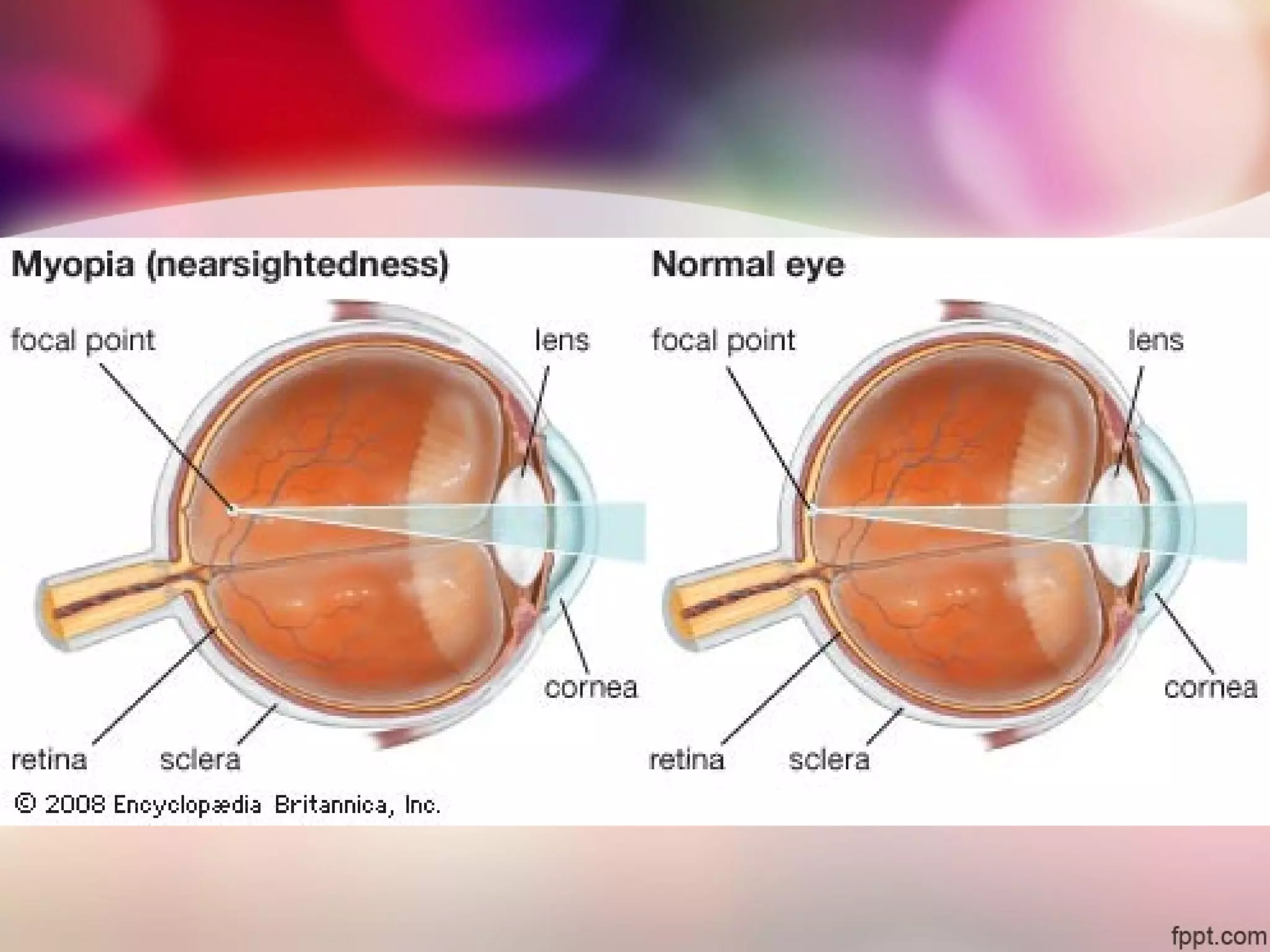 Vision defects and corrective lenses | PPT
