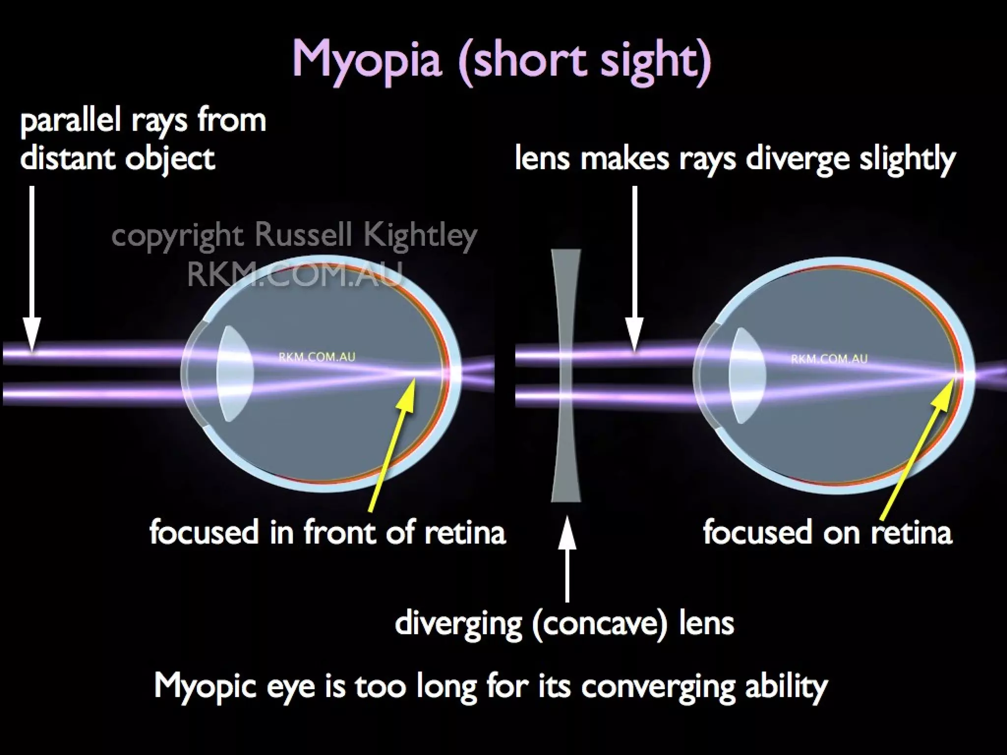 Vision defects and corrective lenses | PPT