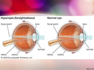 Vision defects and corrective lenses | PPT