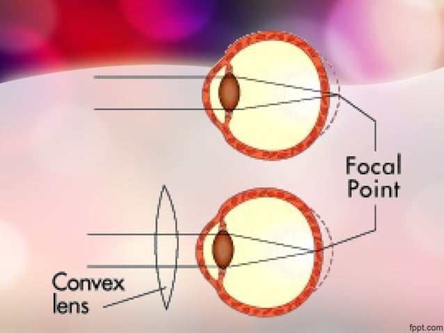 Vision defects and corrective lenses | PPT | Eye and Vision Conditions ...