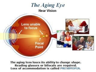 Vision defects and corrective lenses | PPT