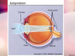 Vision defects and corrective lenses | PPT