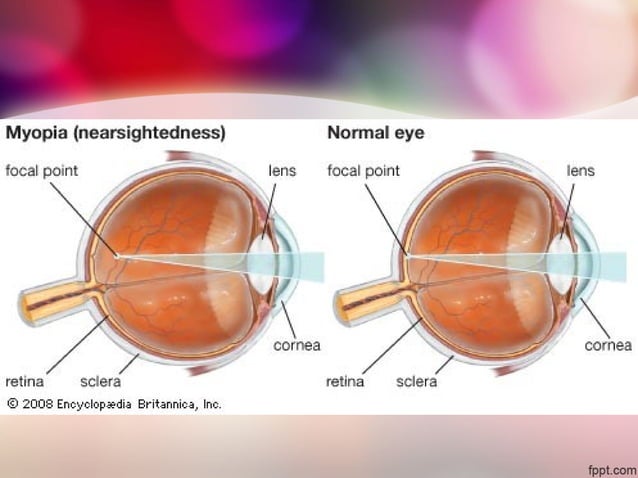 Vision defects and corrective lenses | PPT | Eye and Vision Conditions ...