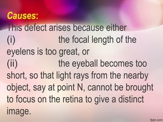 Vision defects and corrective lenses | PPT