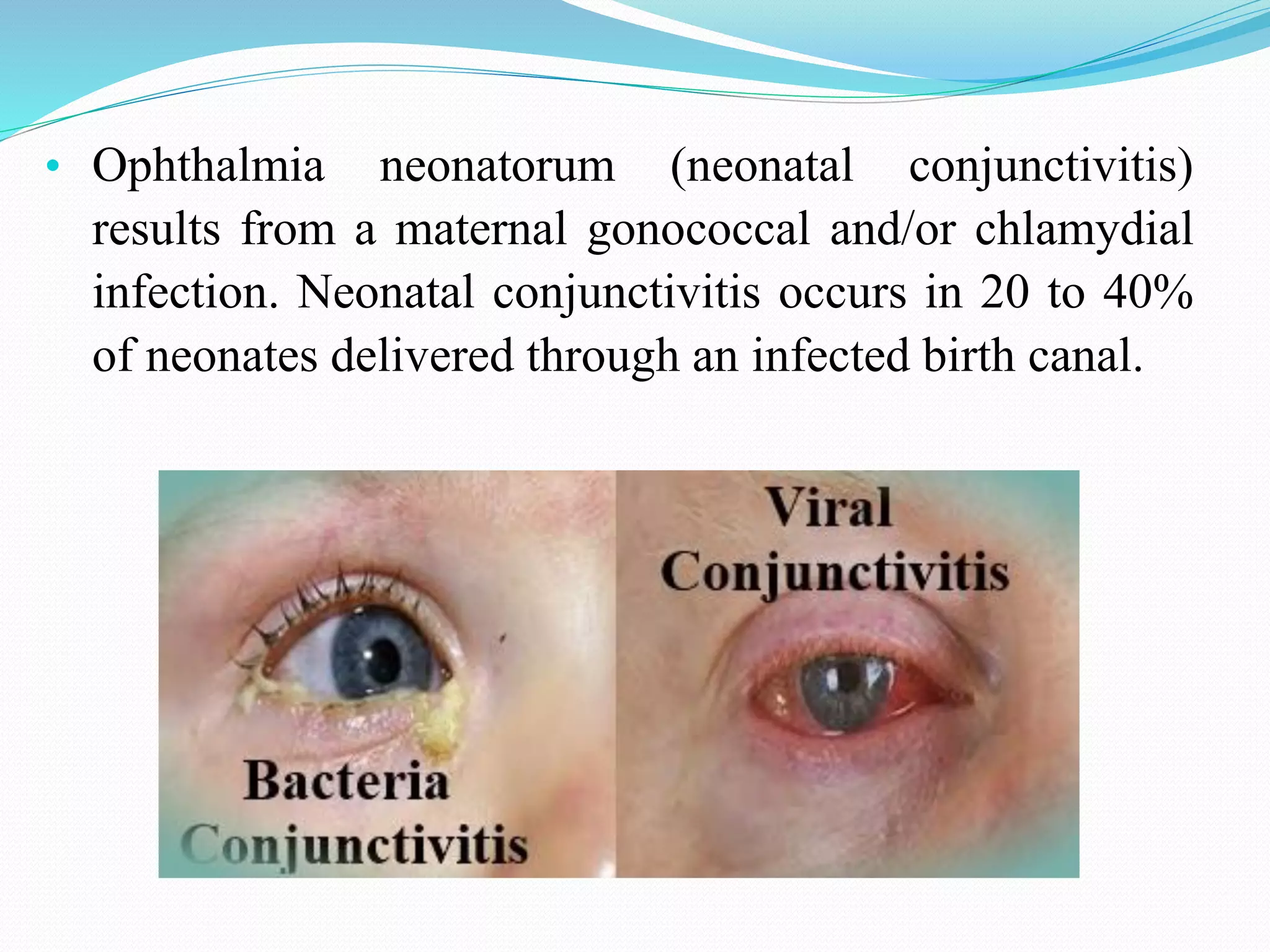 Vision disorder- Conjunctivitis | PDF