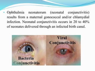 Vision disorder- Conjunctivitis | PDF