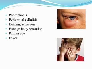 Vision disorder- Conjunctivitis | PDF