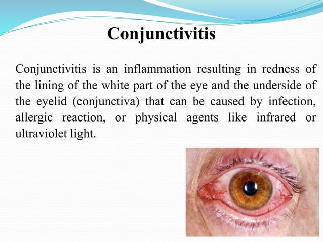 Vision disorder- Conjunctivitis | PDF