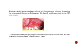 VISTA TECHNIQUE CANINE IMPACTION | PPTX