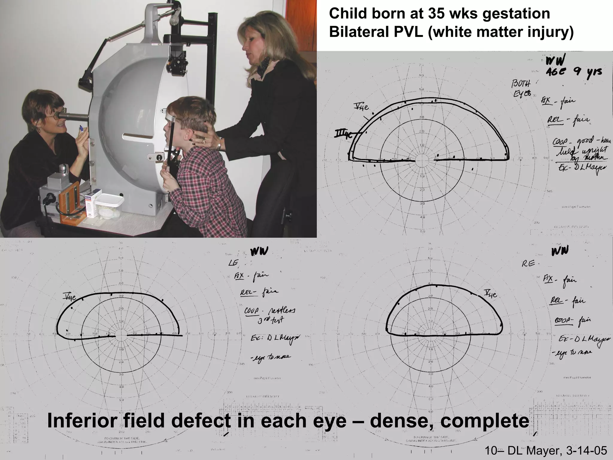 Visual field testing in pediatrics | PPT