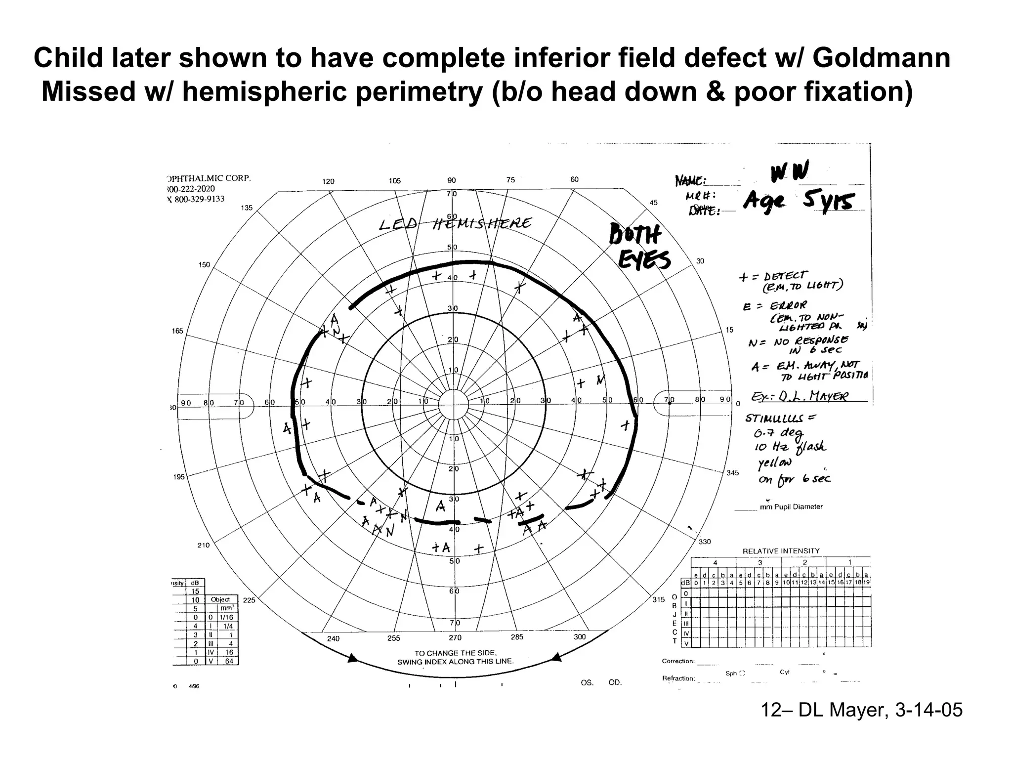 Visual field testing in pediatrics | PPT