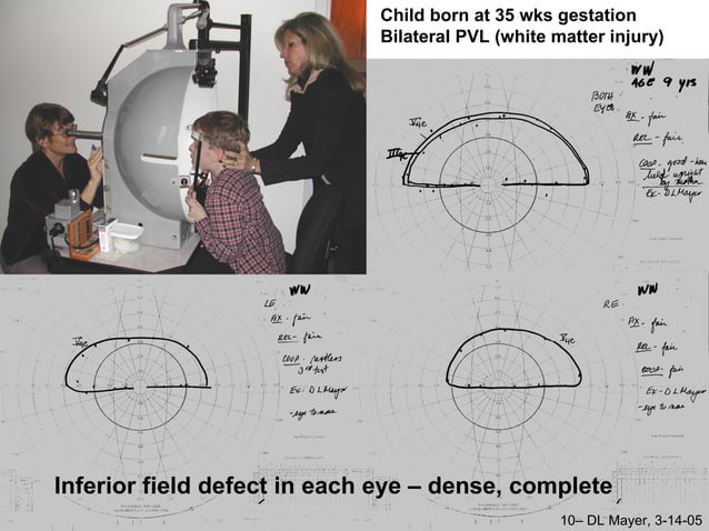 Visual field testing in pediatrics | PPT