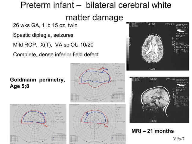 Visual field testing in pediatrics | PPT