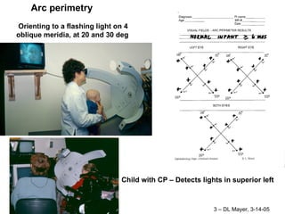 Visual field testing in pediatrics | PPT