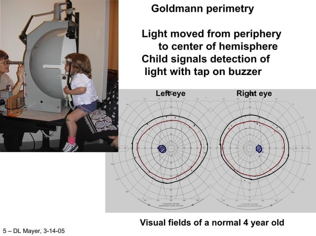 Visual field testing in pediatrics | PPT