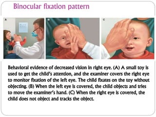 Visual acuity in infants | PPTX