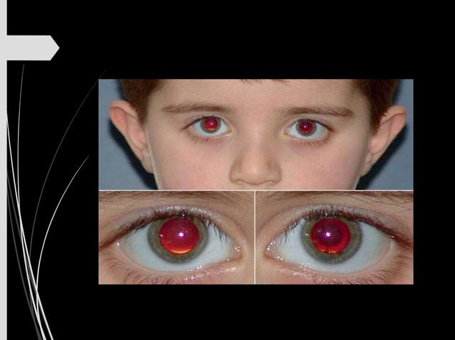 Visual acuity test in infants | PPT
