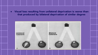 Visual axis deprivation amblyopia.pdf