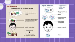 Visual axis deprivation amblyopia.pdf