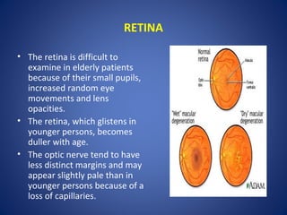 Visual changes in aging | PPT
