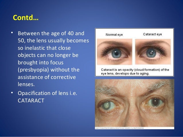 Visual changes in aging