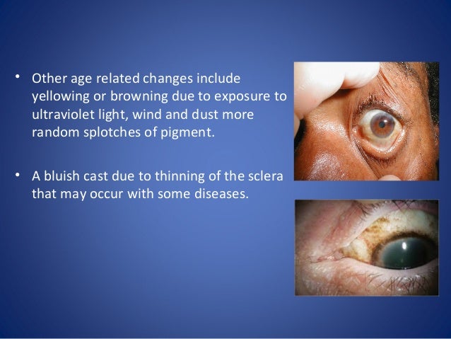 Visual changes in aging
