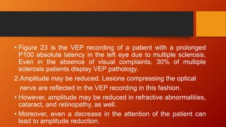 Visual evoked potential by arfa sultana | PPTX
