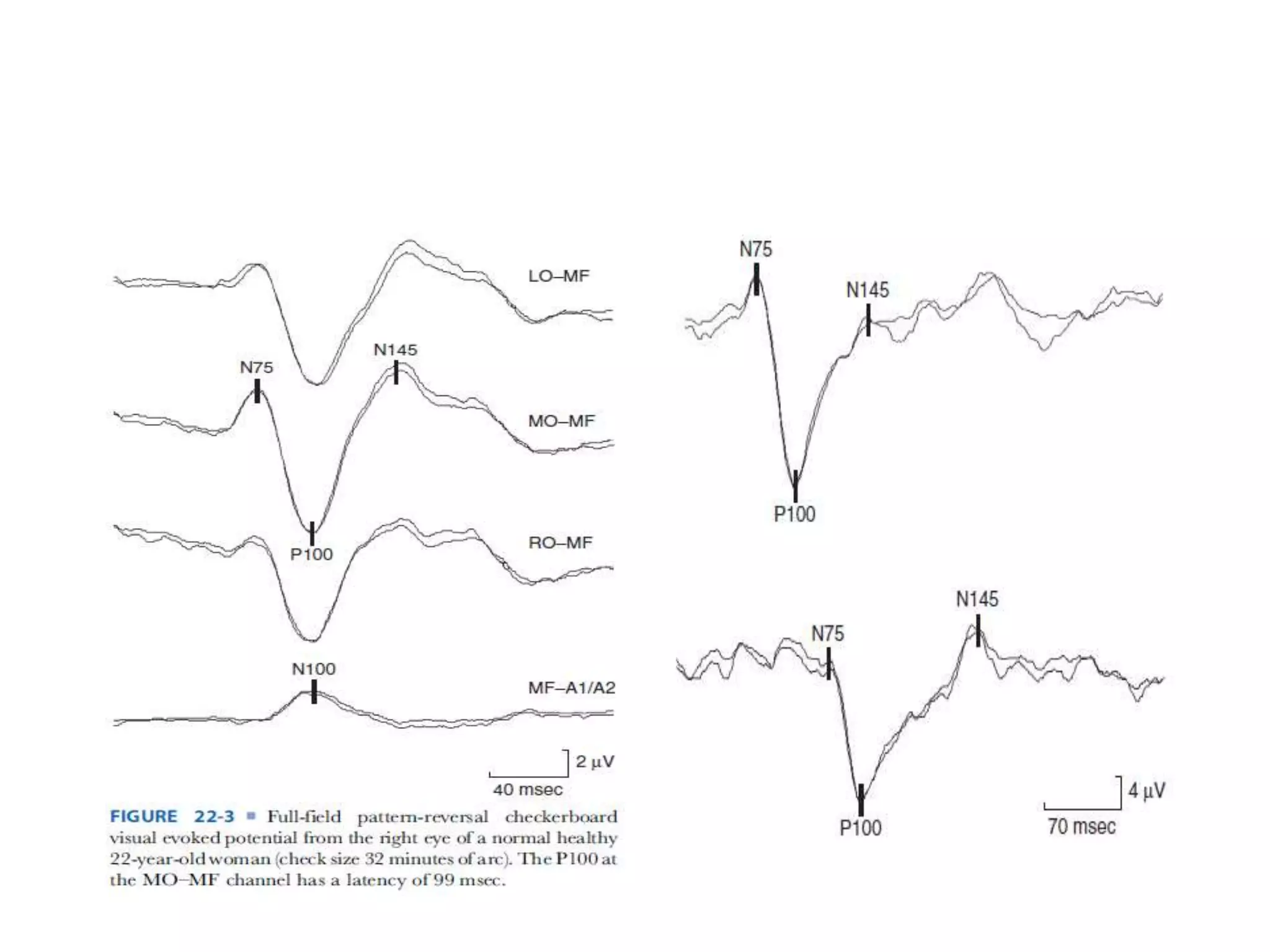 Visual evoked potentials | PPTX