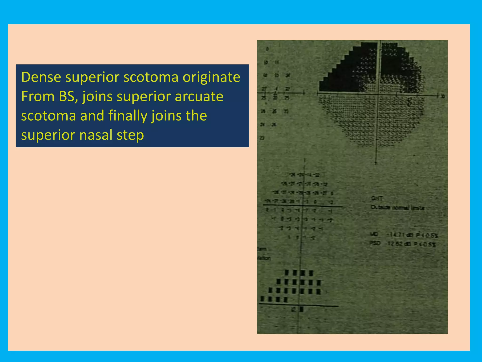 Visual field analysis--interpretation | PPTX