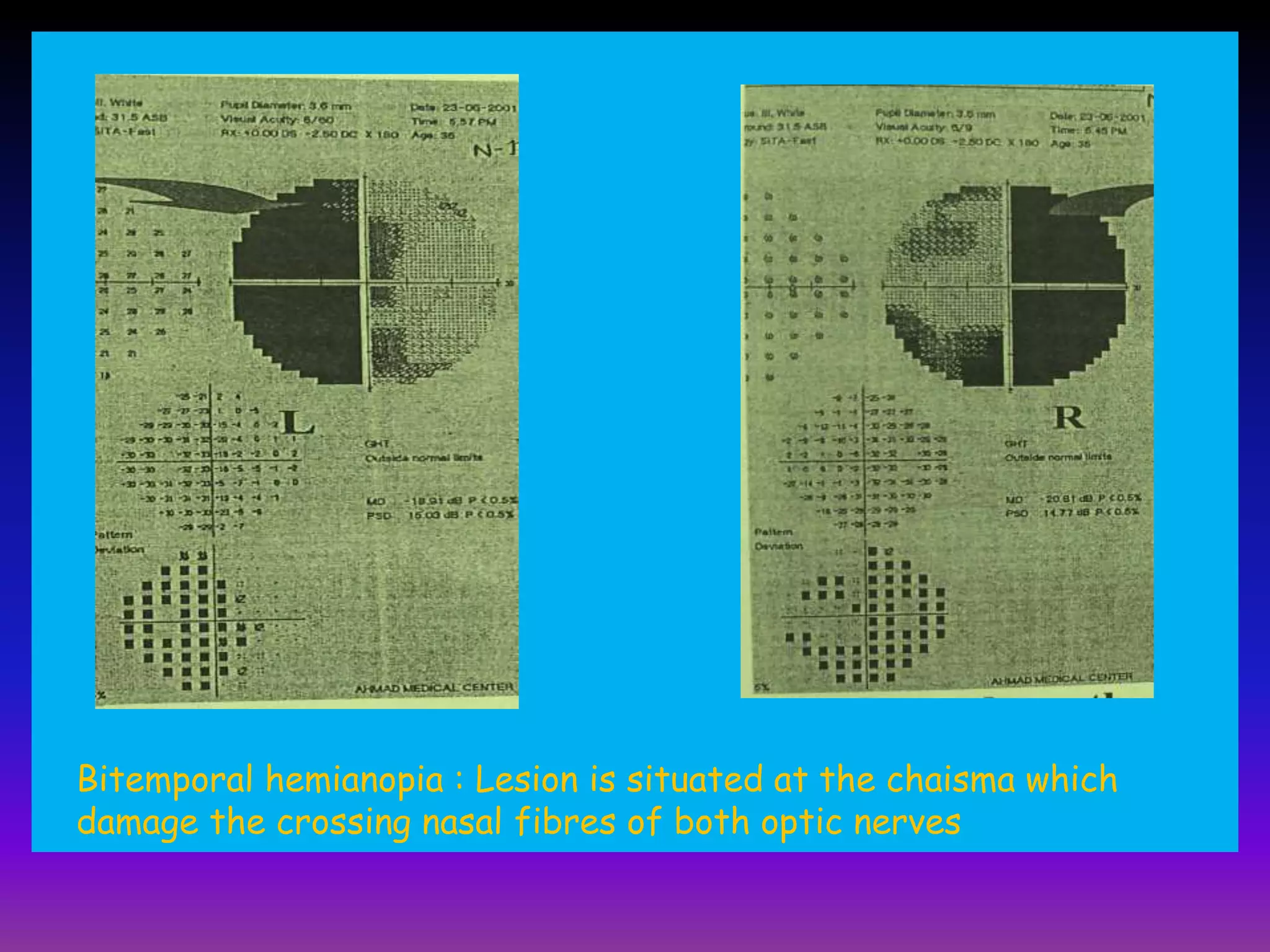 Visual field analysis--interpretation | PPTX