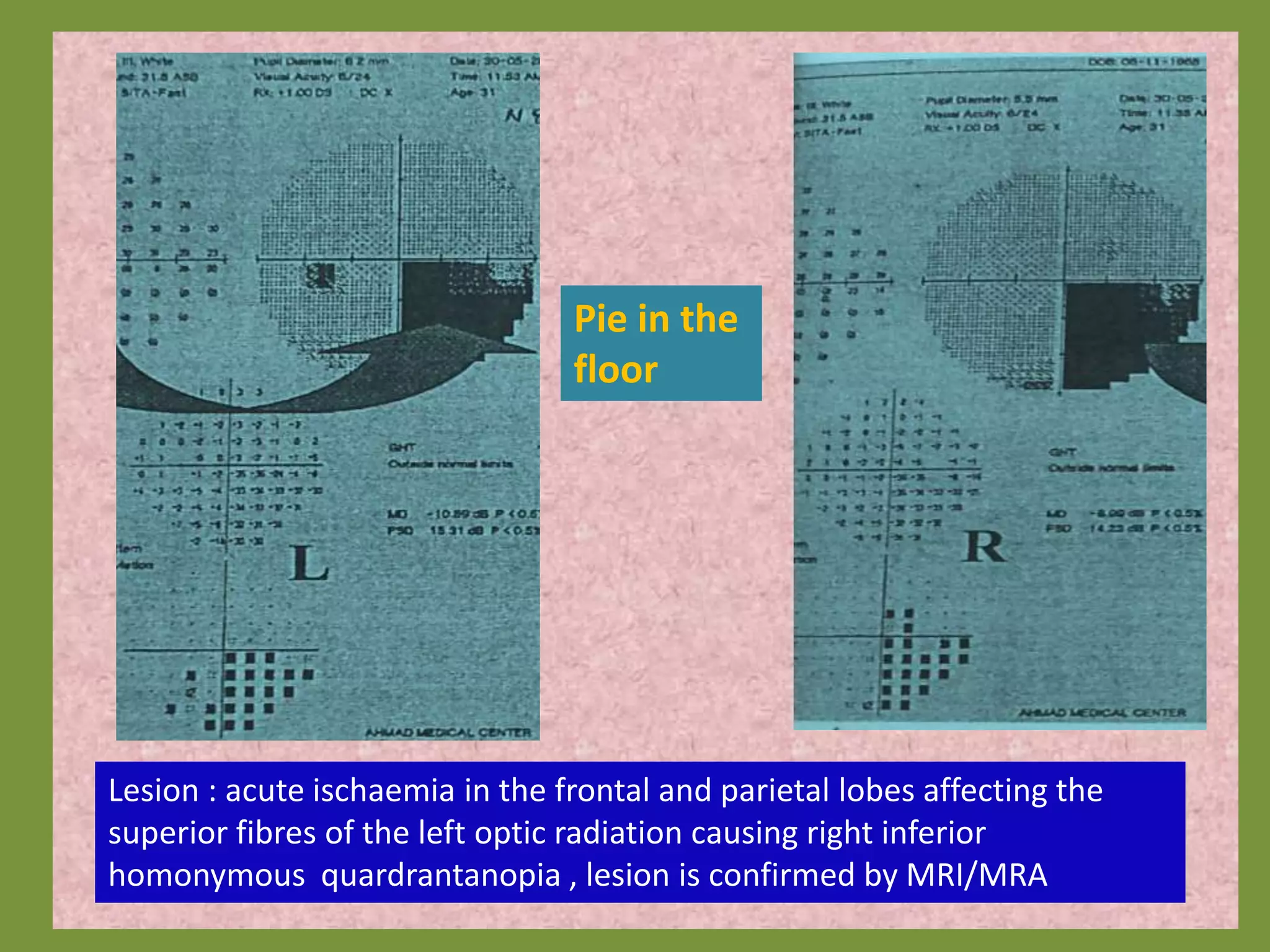 Visual field analysis--interpretation | PPTX | Eye and Vision ...