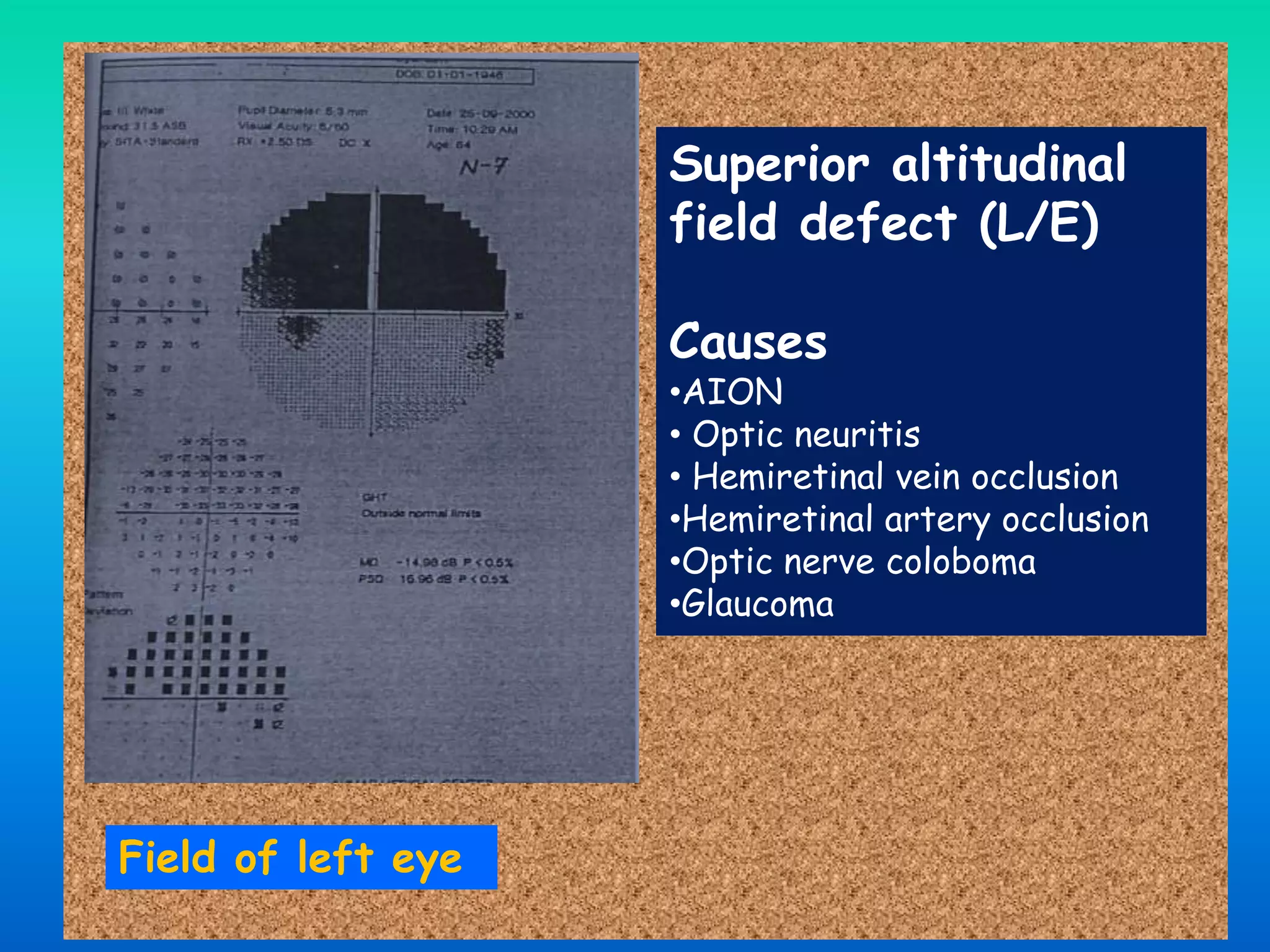 Visual field analysis--interpretation | PPTX