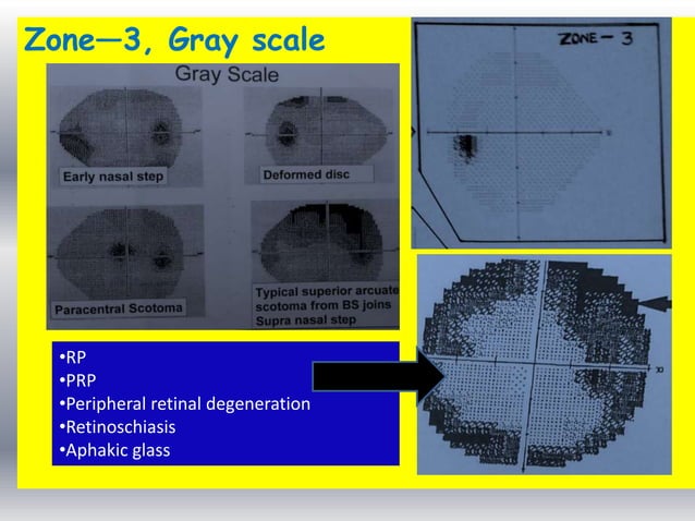 Visual field analysis--interpretation | PPTX | Eye and Vision ...