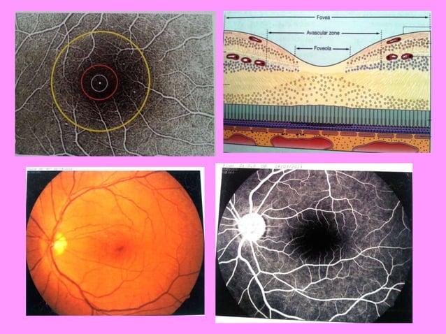 Visual field analysis--interpretation | PPTX | Eye and Vision ...
