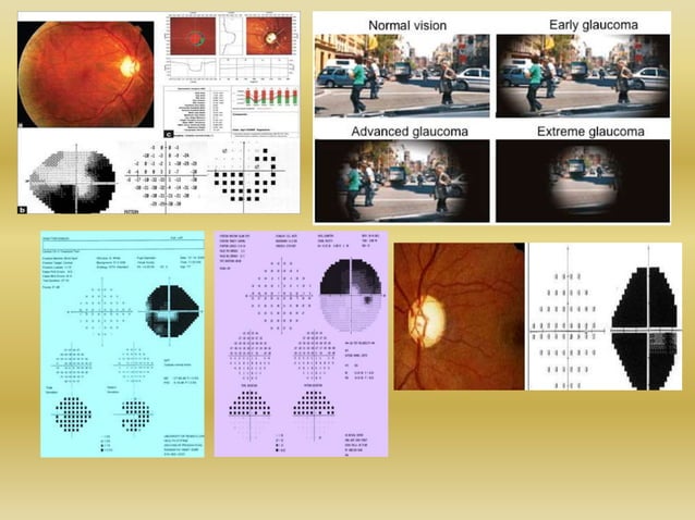 Visual field analysis--interpretation | PPTX | Eye and Vision ...