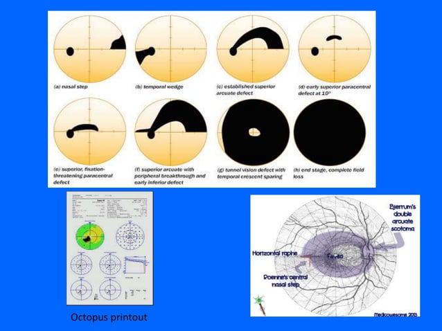 Visual field analysis--interpretation | PPTX | Eye and Vision Conditions | Diseases and Conditions