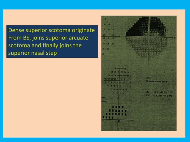 Visual field analysis--interpretation | PPTX | Eye and Vision ...